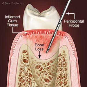 Periodontal Surgery – Dentist Southgate